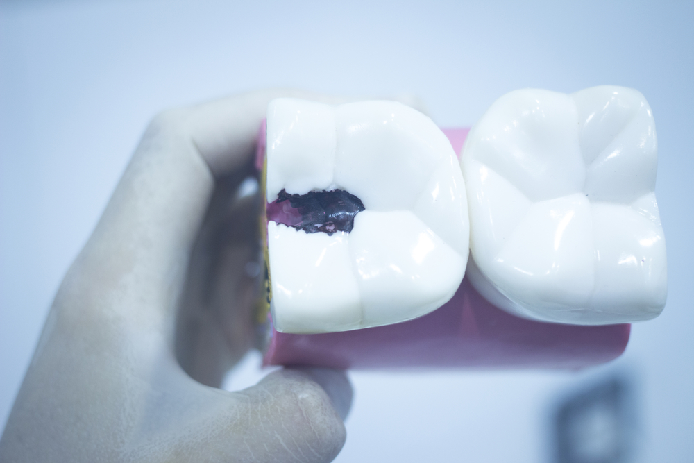 Todo Lo Que Debes Saber Sobre Los Empastes Clínica Dental En Ciudad